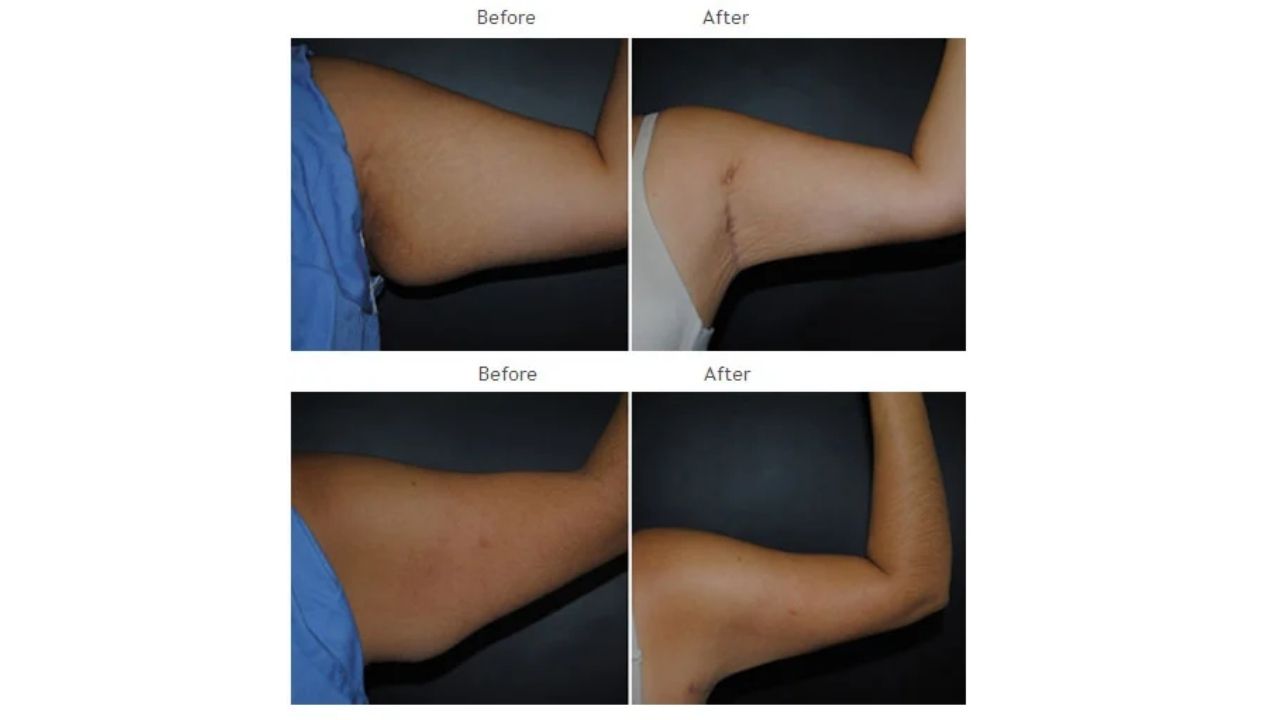 Arm and Thigh Lift Surgery | East Bay Dermatology & Plastic Surgery